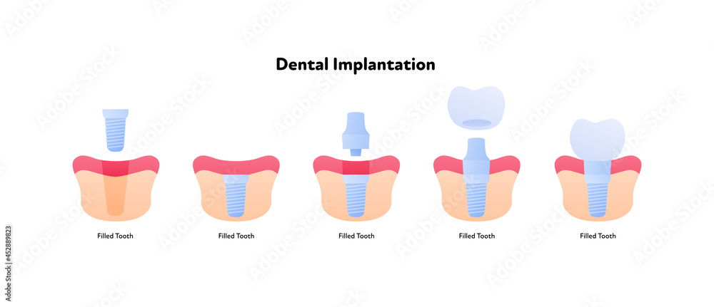 Tooth implant chart. Vector biomedical illustration. Cross section ...