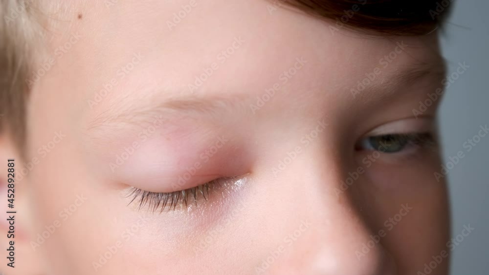 Face of boy with a swollen eye from an insect bite, closeup view ...