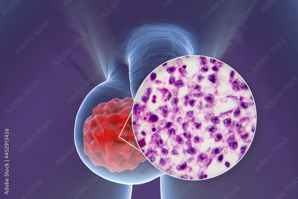 Testicular cancer, testicular seminoma, medical 3D illustration and ...