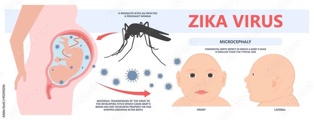 small head zika virus down autism birth defect baby brain infant fetus ...