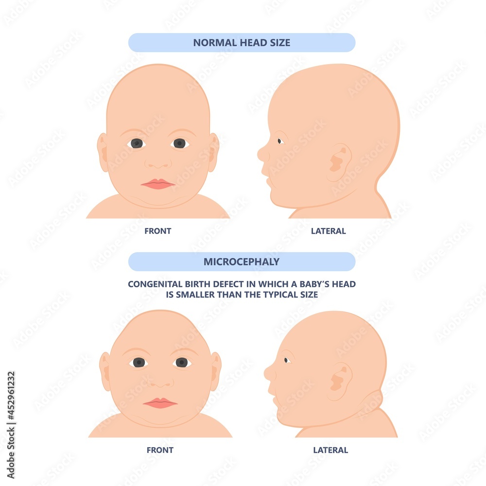 small head zika virus down autism birth defect baby brain infant fetus ...