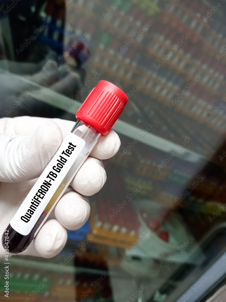 Blood Sample For QuantiFERON TB Gold Test For Diagnosis Of Tuberculosis Latest Name IGRA Stock blood-sample-for-quantiferon-tb-gold-test-for-diagnosis-of-tuberculosis-latest-name-igra-stock