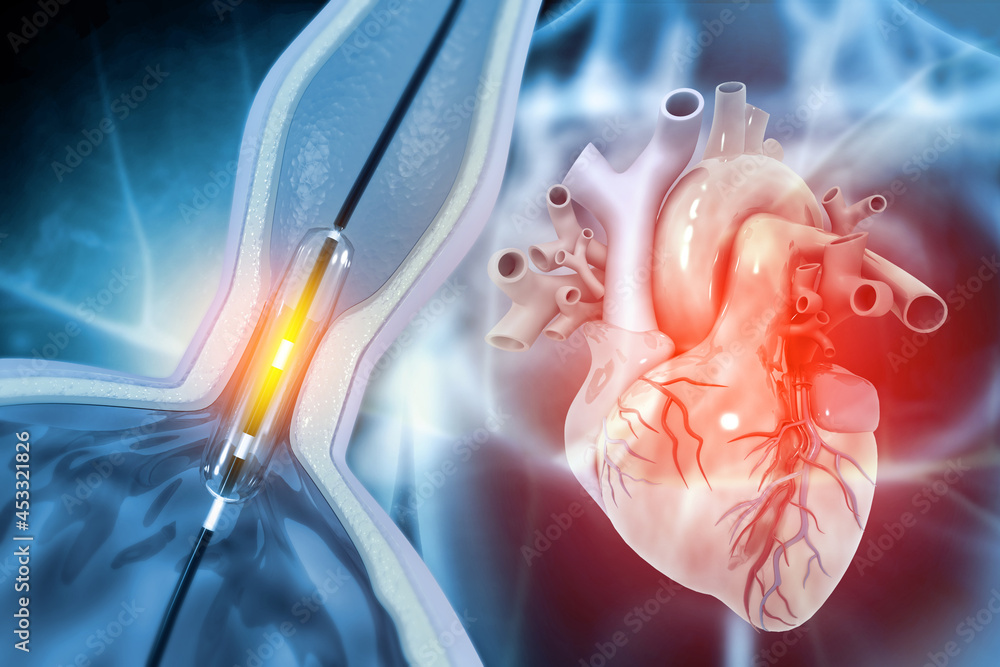 Human heart with Balloon angioplasty. 3d illustration Stock ...