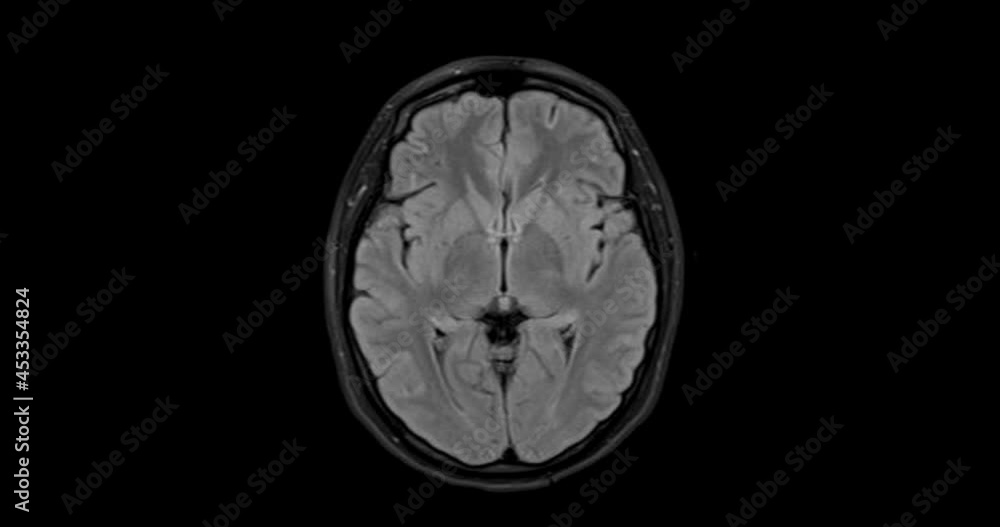 MRI of the brain. Human skull vertical projection. Medical footage ...