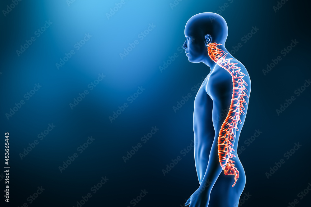 Kyphosis pathology with man model from lateral view 3D rendering ...