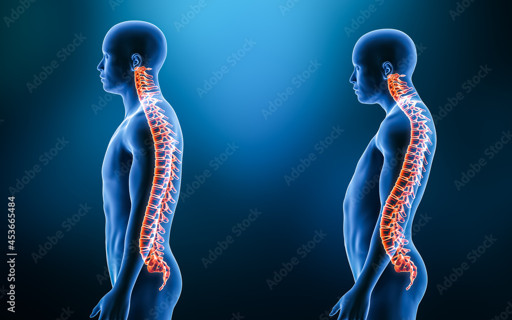 Comparison between normal backbone and lordosis curvature of the spine ...