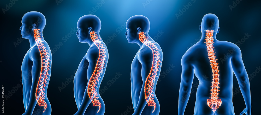 Three main curvatures of the spine disorders or deformities on male ...