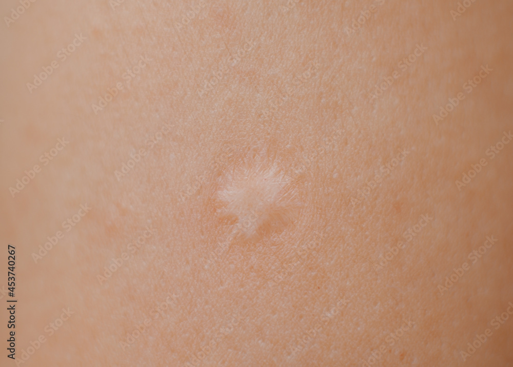 Scar on the shoulder after vaccination with Bacillus Calmette-Gurin ...