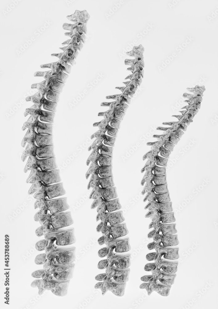 Osteoporosis curvature stages of the spine - 3D Rendering Stock ...