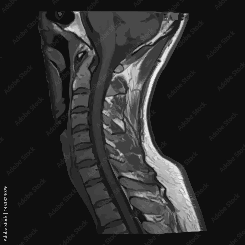 Realistic image sagittal of cervical spine with CT scan, MRI Magnetic ...