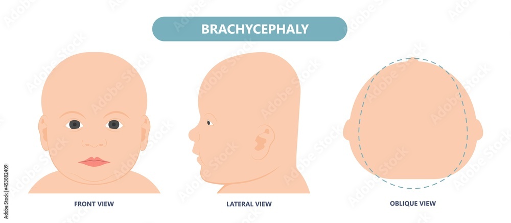 Vecteur Stock craniosynostosis helmet pillow flat head autism brain ...