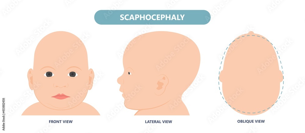 craniosynostosis helmet pillow flat head autism brain skull bone ...