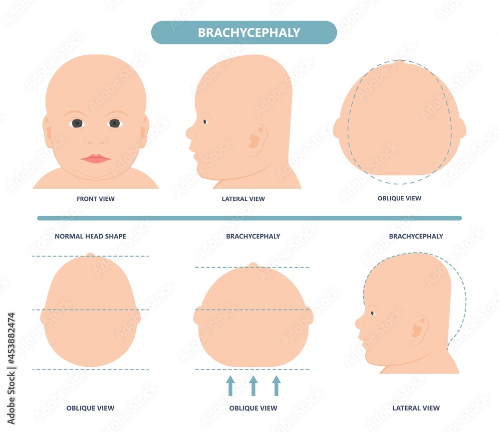 craniosynostosis helmet pillow flat head autism brain skull bone ...