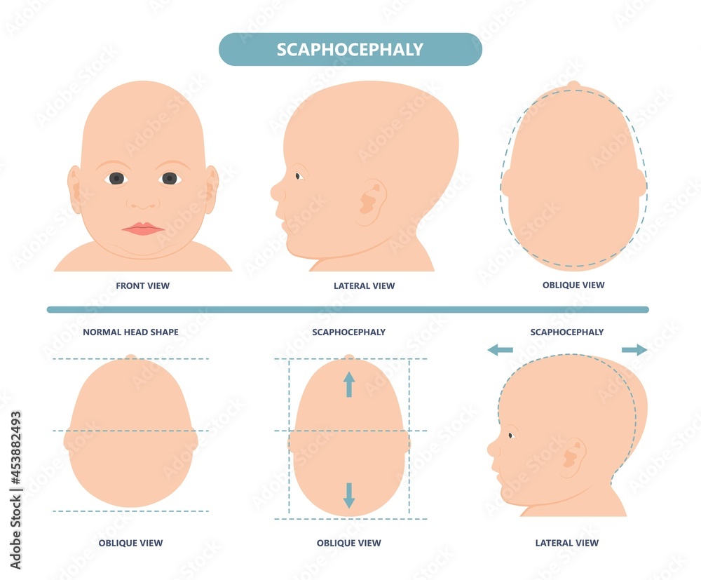 craniosynostosis helmet pillow flat head autism brain skull bone ...