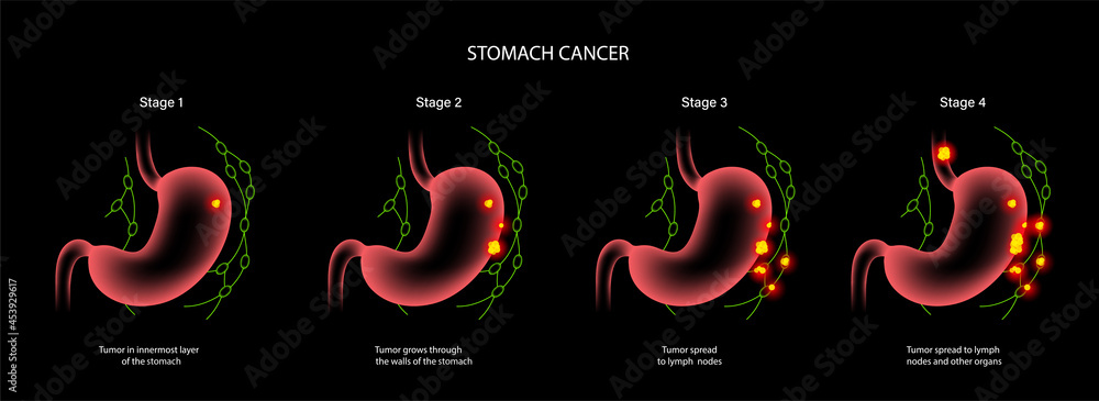 Stomach cancer anatomy Stock Vector | Adobe Stock