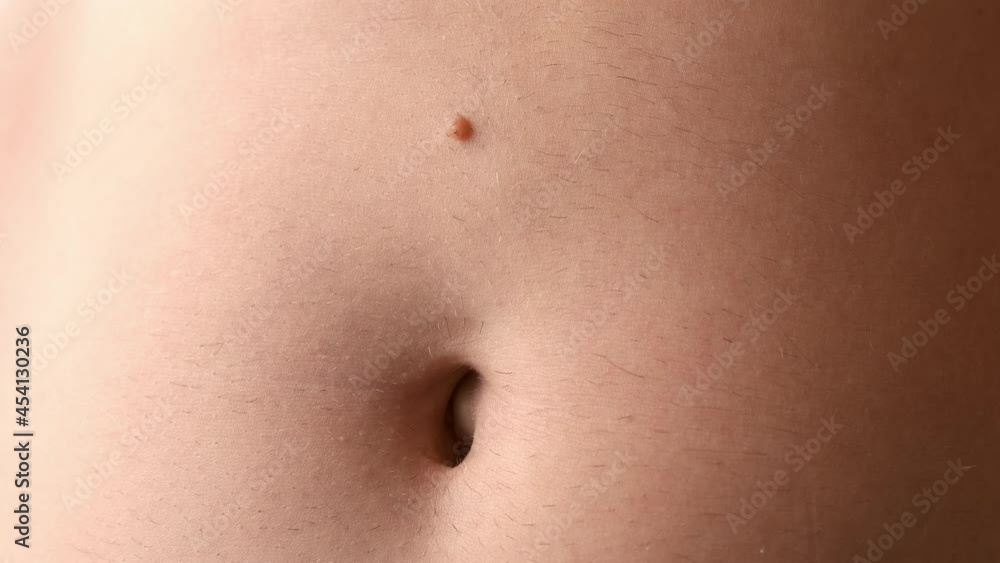 Large protruding mole wart on the man's stomach above the navel ...