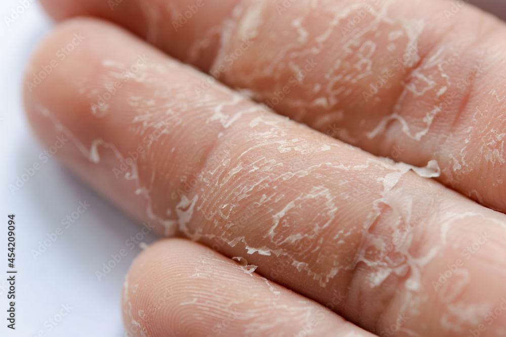 Peeling skin on hand and fingers. Desquamation Stock Photo | Adobe Stock