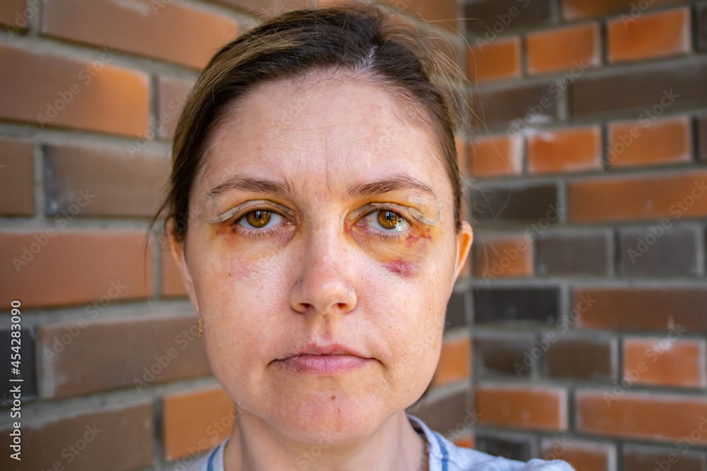 Double Eyelid Surgery, Eyes Surgery Recover Period, immediately after ...