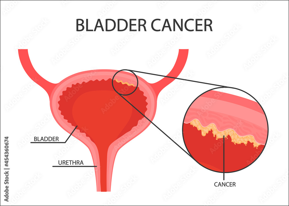 Human bladder cancer. malignant cells concept. Vector in cartoon style ...