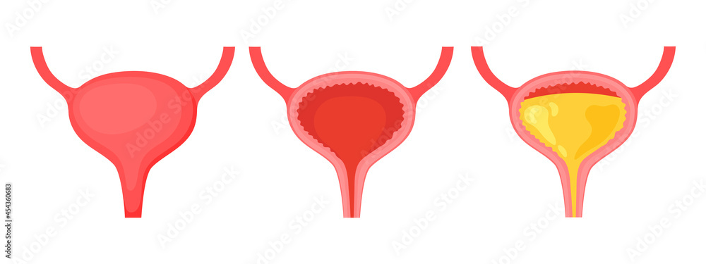 A full and empty bladder. Human organ anatomy. Medical, medical and ...