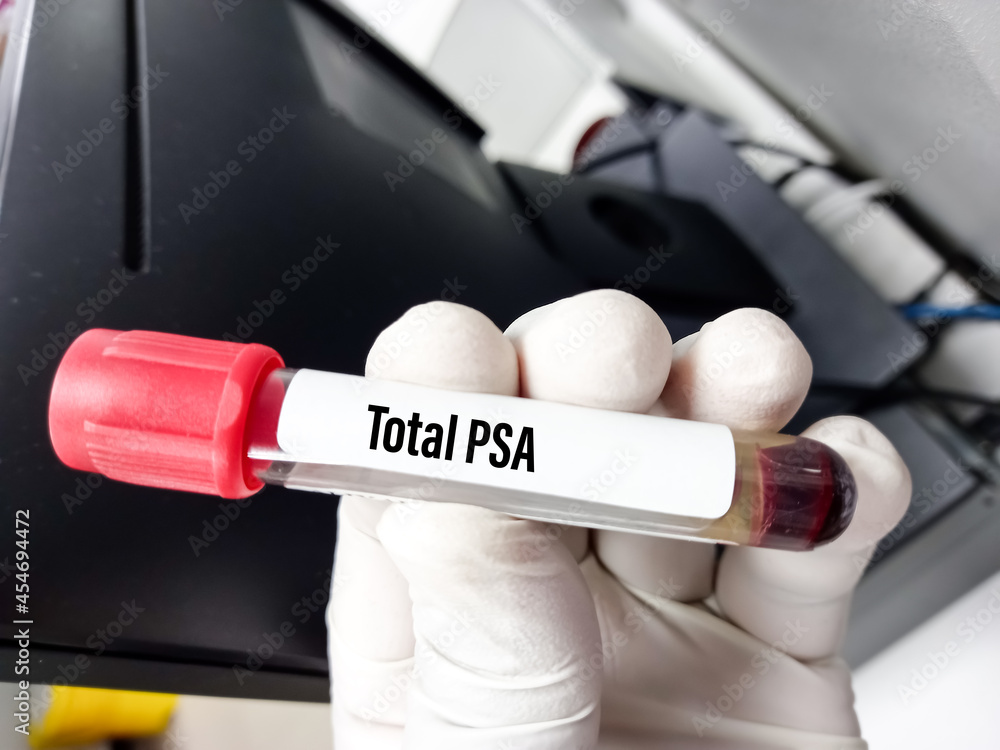 Blood sample for Total PSA (Prostate-specific antigen) Test, diagnosis ...