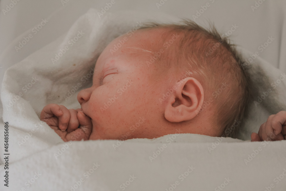 Stockfoto Newborn baby with blood vessels visible on face due to fast ...