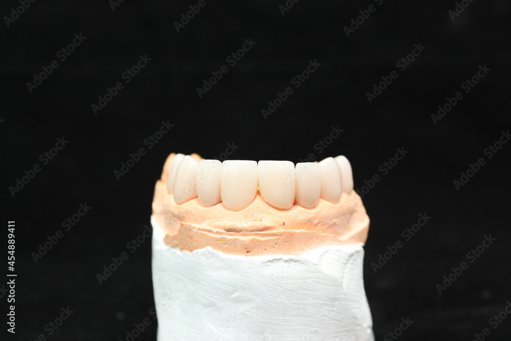 Dental crowns in the plaster model for treatment and new smile Stock ...