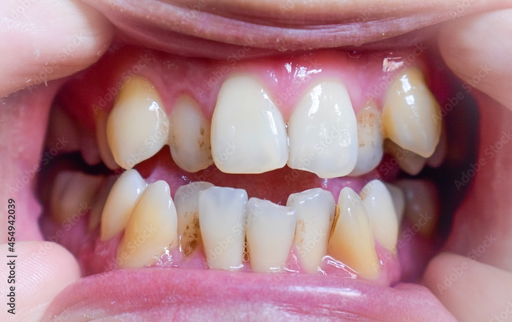 Stacked or overlapping teeth of Asian man. Also called crowded teeth ...