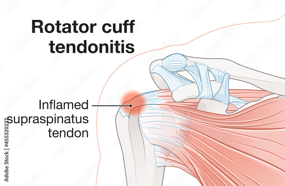 Shoulder anatomy. Rotator cuff tendonitis Stock Illustration | Adobe Stock