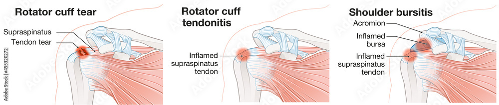 Shoulder pain. Rotator cuff tear. Tendonitis. Bursitis Stock ...
