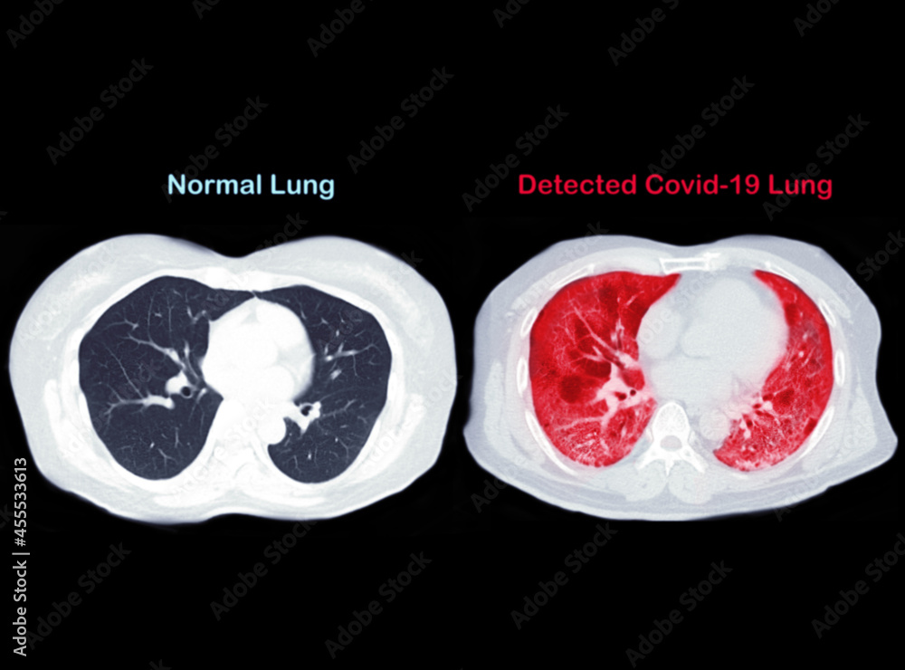 Compare CT scan of Chest axial view of normal lung and lung infection ...
