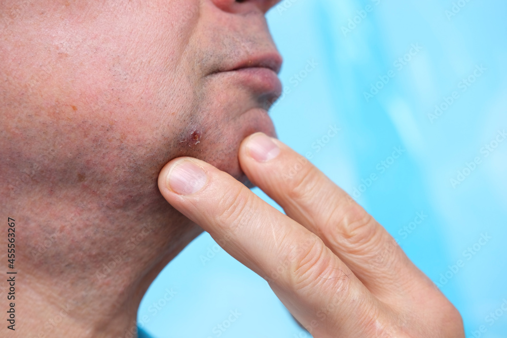 man with a herpes wound on the chin, viral skin rashes with weakened ...