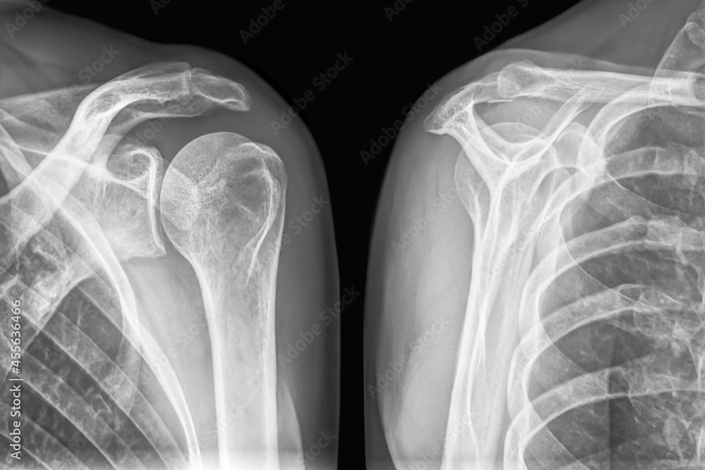 X-ray image of front and back view of a female healthy body. Xray image ...