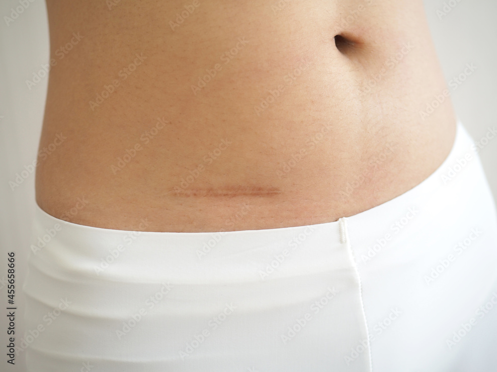 Scar on woman's stomach from appendectomy. closeup photo, blurred ...
