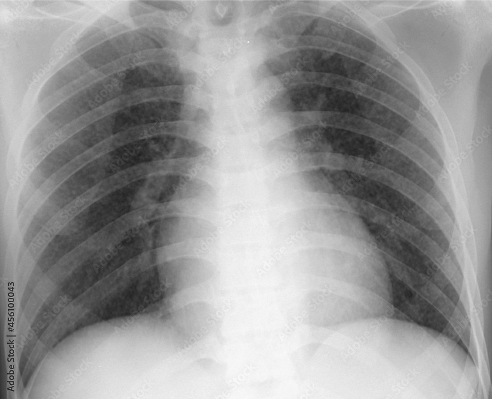 x ray image of miliary nodule lung tuberculosis Stock 写真 | Adobe Stock