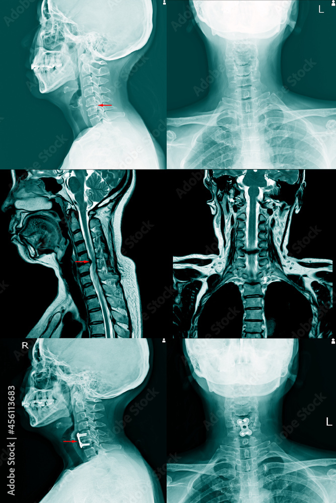 X-ray C- Spines and MRI scan of a patient with chronic upper ...