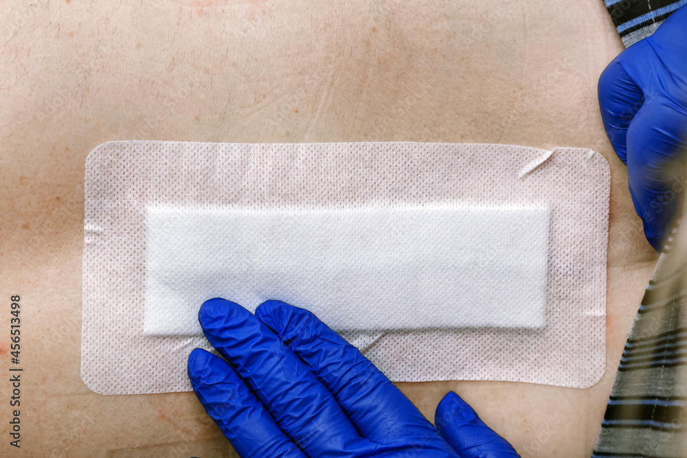 Nurse hand patching mole removal surgery incision as epidermal ...