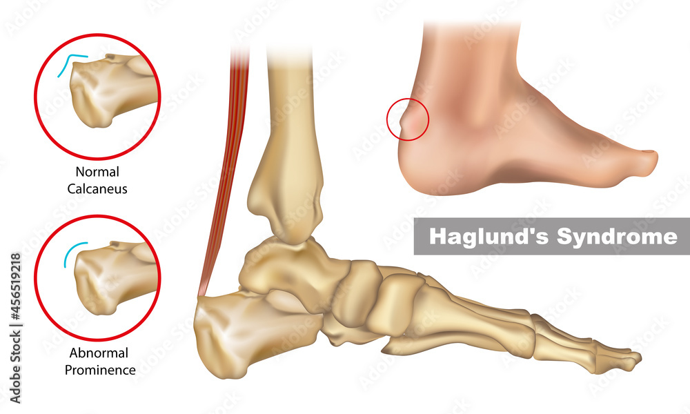 Haglund's deformity is an abnormality of the bone and soft tissues in ...