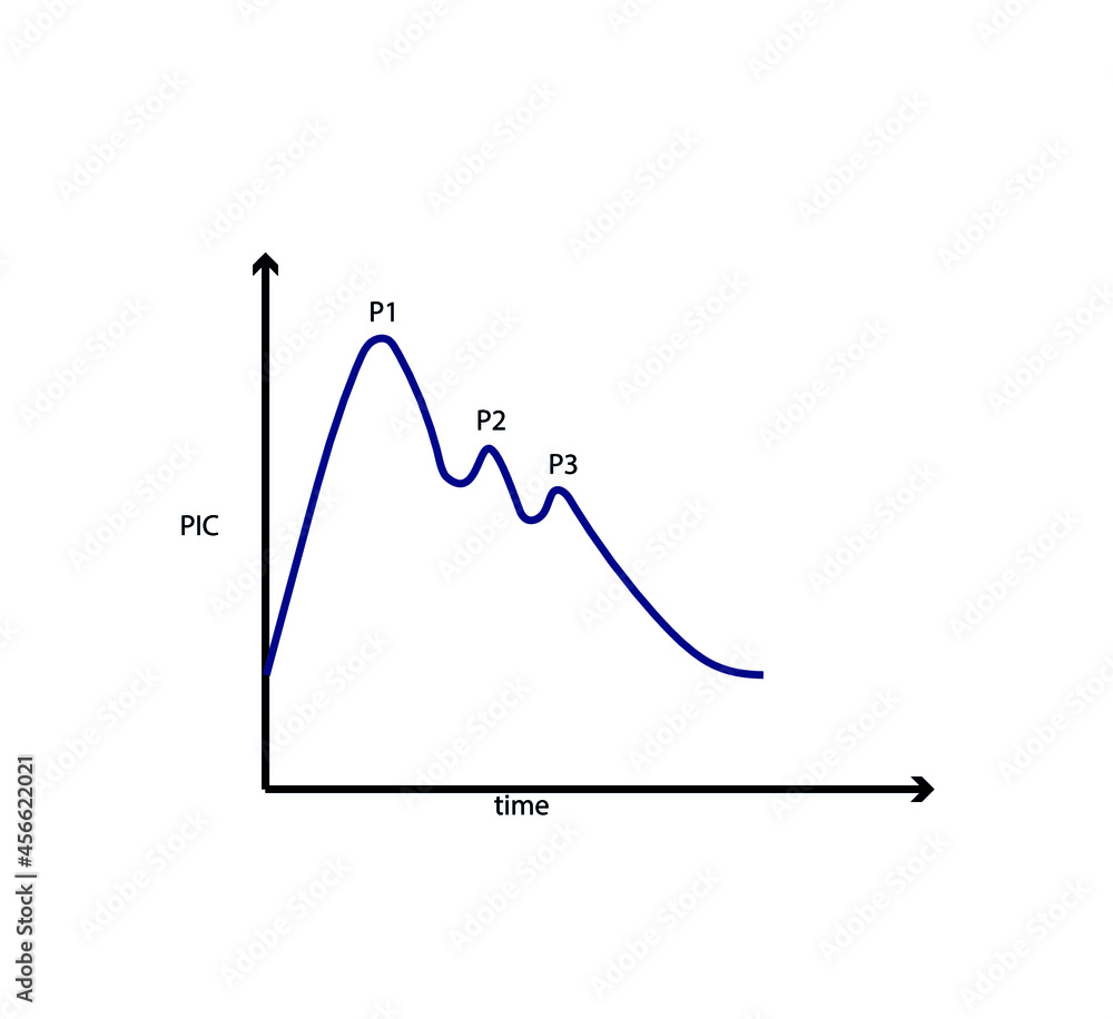 Intracranial Pressure Monitoring Icp Waveform Stock Vector Adobe Stock