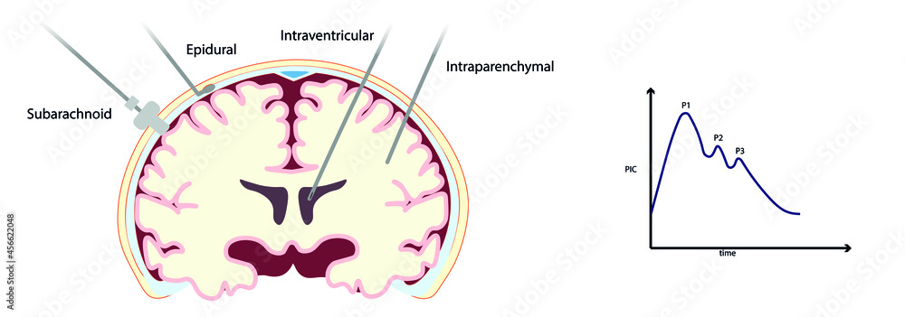 Intracranial Pressure Monitoring (ICP) monitoring device placement in a ...