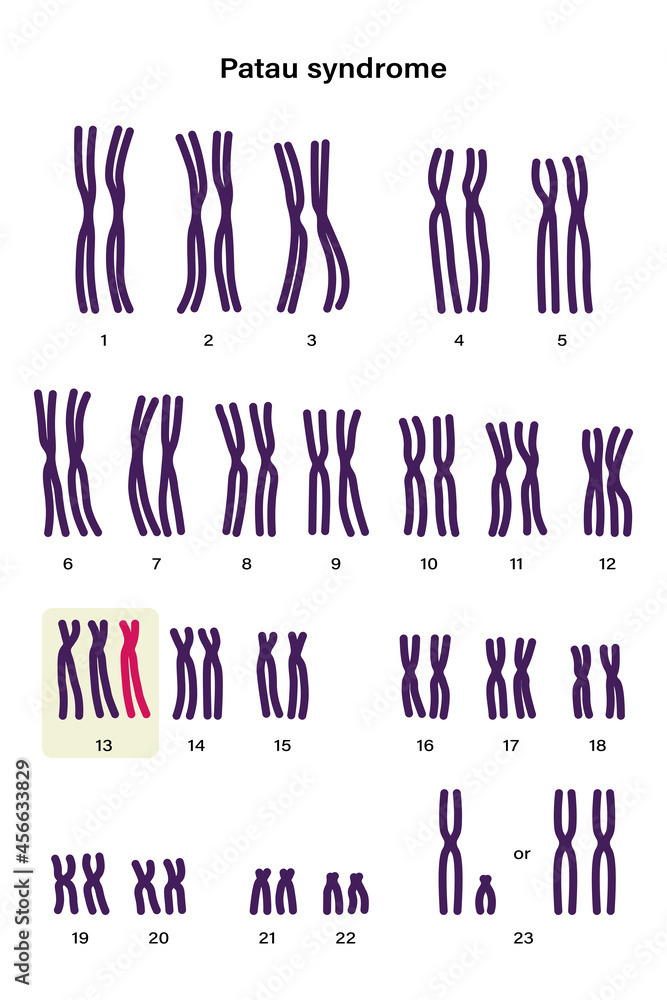 Human karyotype of Patau syndrome. Autosomal abnormalities. Patau ...
