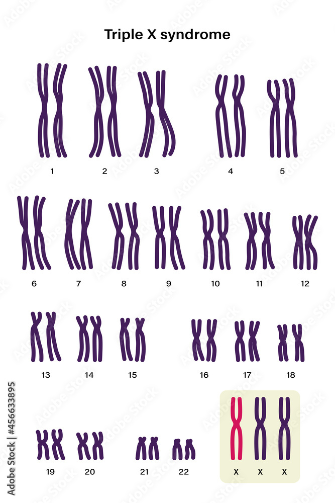 Human karyotype of Triple x syndrome. XXX. Female has an extra X ...