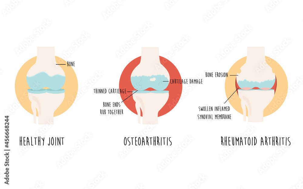 Vector diagram with healthy joint and joint with osteoarthritis ...