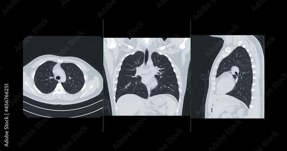 Vidéo Stock Collection of CT Chest or CT Lung axial, coronal and sagittal view for diagnostic ...