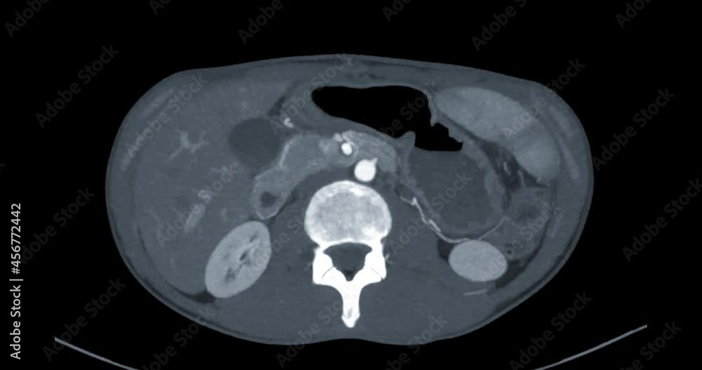 CTA whole aorta axial MIP view for diagnosis aortic aneurysm. Stock ...