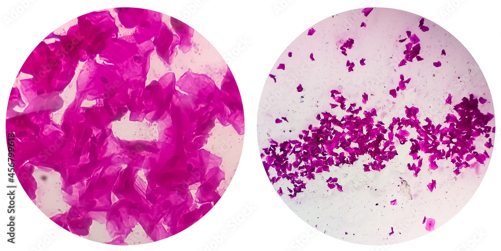 college of two microscopic image of high vaginal swab Gram stain smear ...