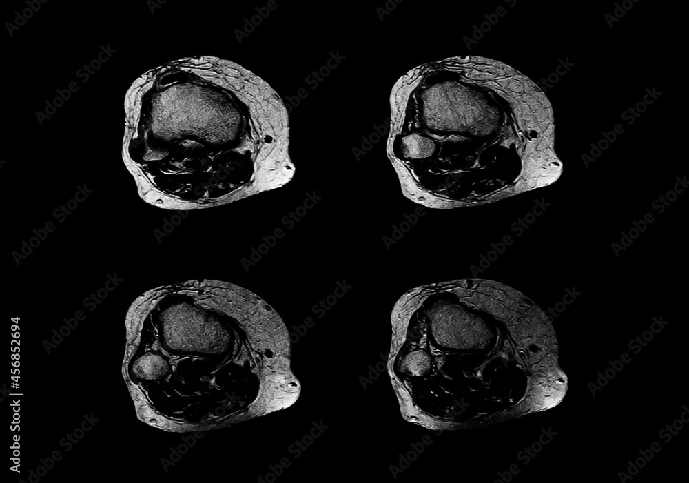 Mri and Ct Scan images with bone and brain ภาพถ่ายสต็อก | Adobe Stock