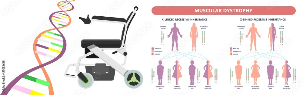 Muscle myopathy gene DNA cell damage Becker type Limb Girdle x linked ...