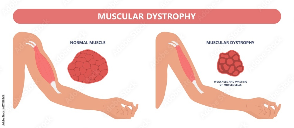 Naklejka Muscle myopathy gene DNA cell damage Becker type Limb Girdle x ...