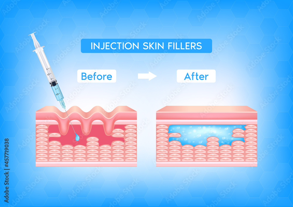 Injection filler injection under the skin on face with wrinkle dermal ...